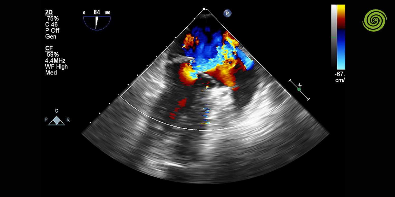 Doppler: qué es, cómo funciona y sus aplicaciones en medicina – GSMED ...